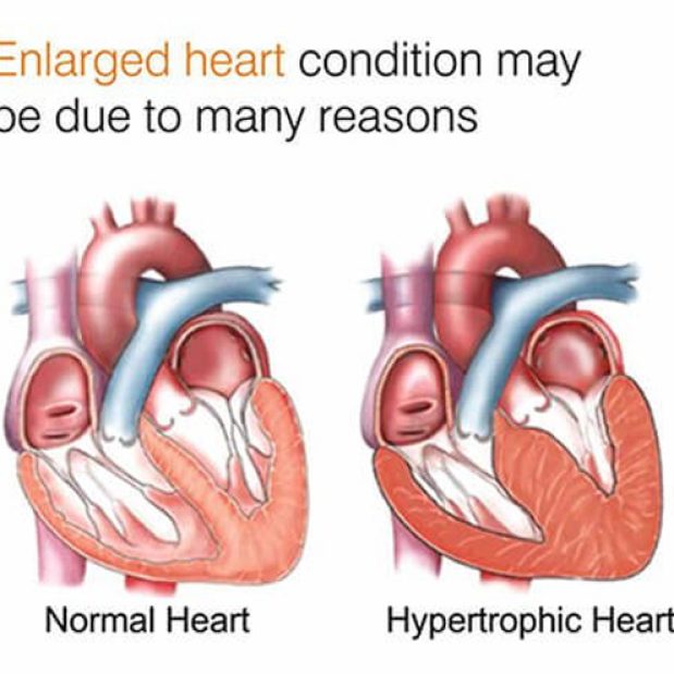 Enlarged Human Heart Enlarged Heart: Symptoms And Causes | Bottom Line