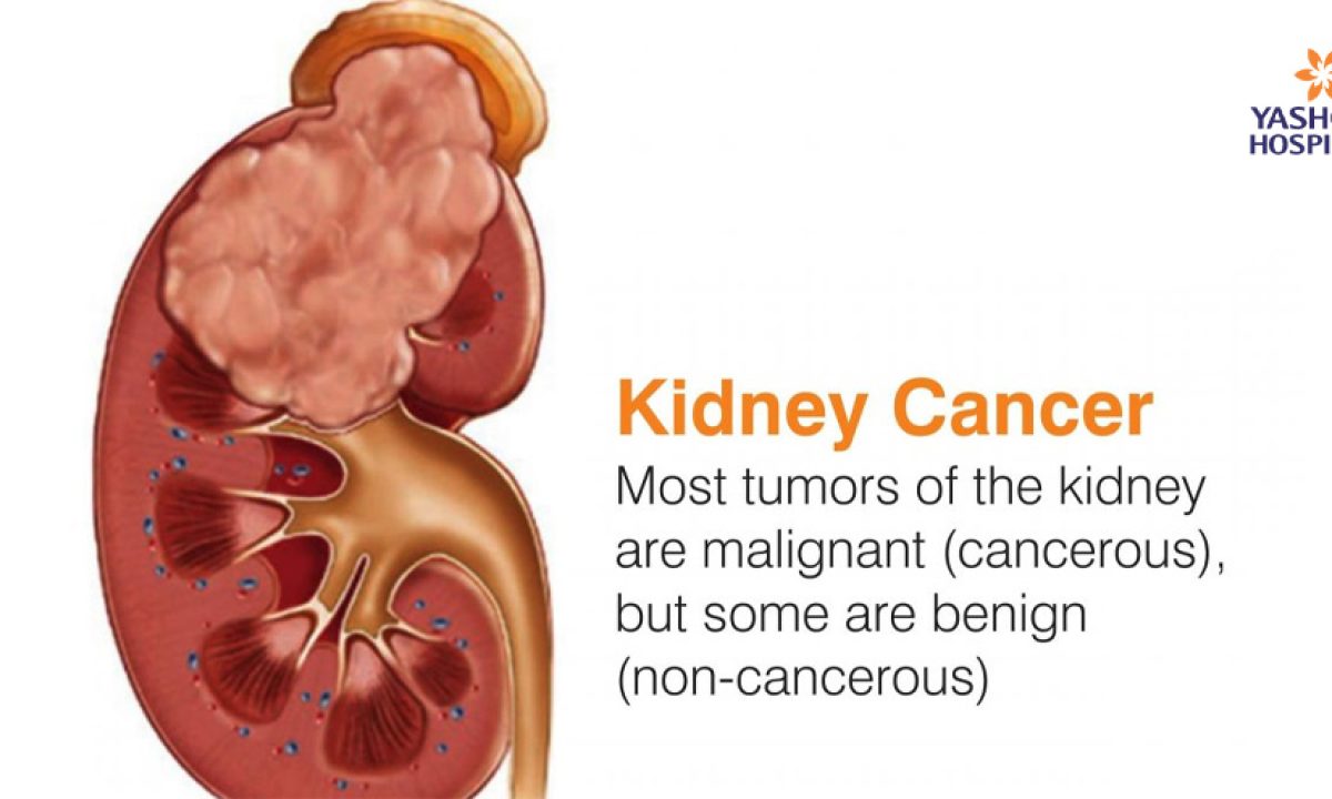 Kidney Tumor Wilms Tumor And Other Childhood Kidney Tumors Treatment