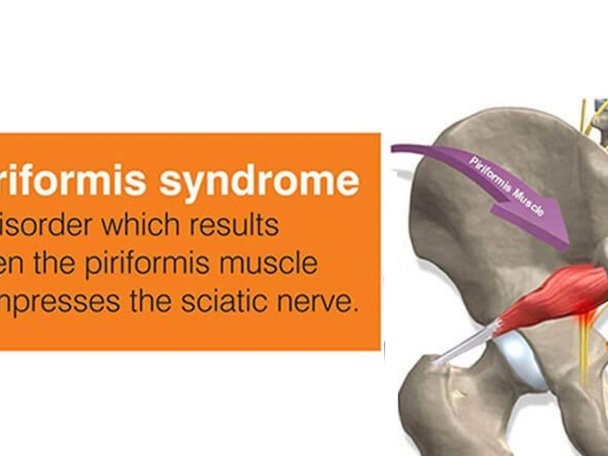 What Is Piriformis Syndrome A Guide To Symptoms Causes And