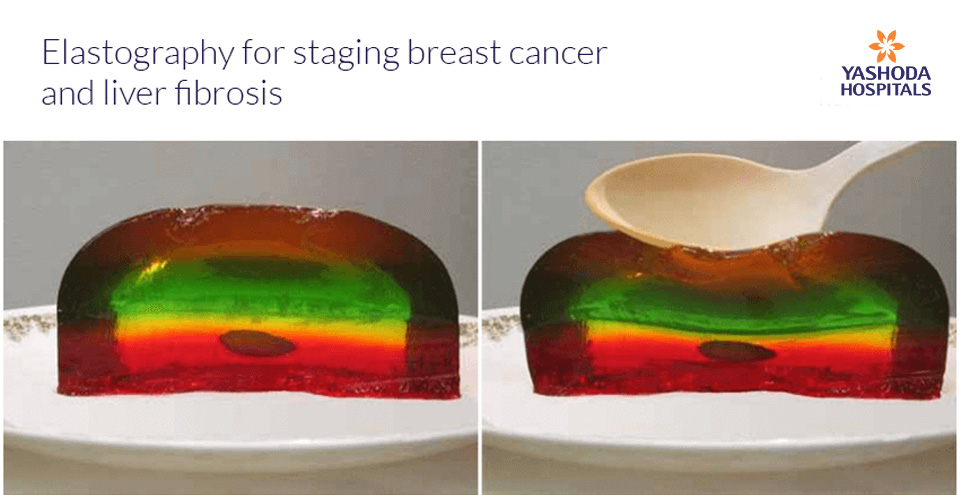 Ultrasound Elastography and MR Elastography for Assessing Liver Fibrosis