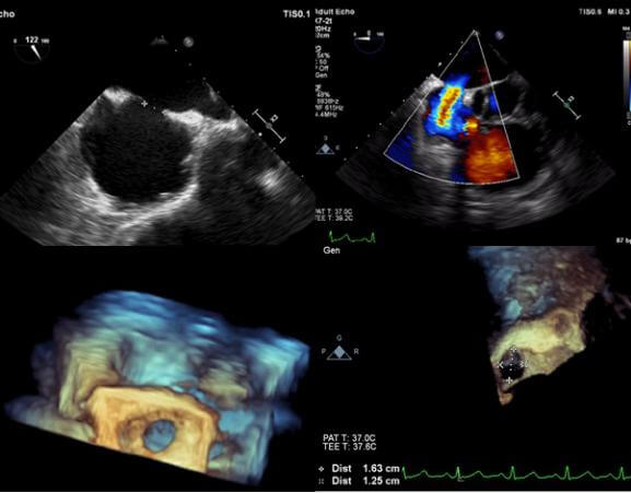 Atrial Septal Defect closure using 3D-Transesophageal echocardiography