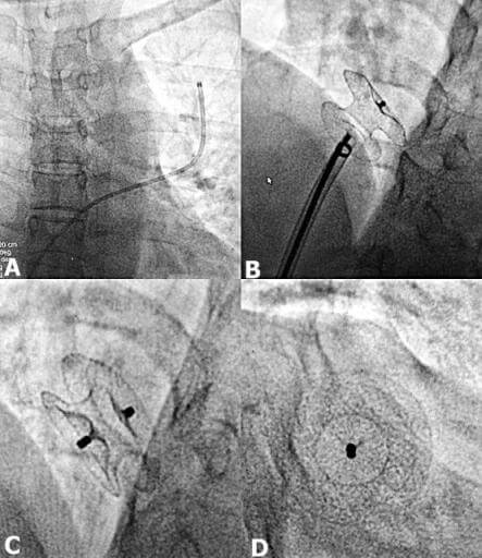 Atrial Septal Defect closure using 3D-Transesophageal echocardiography