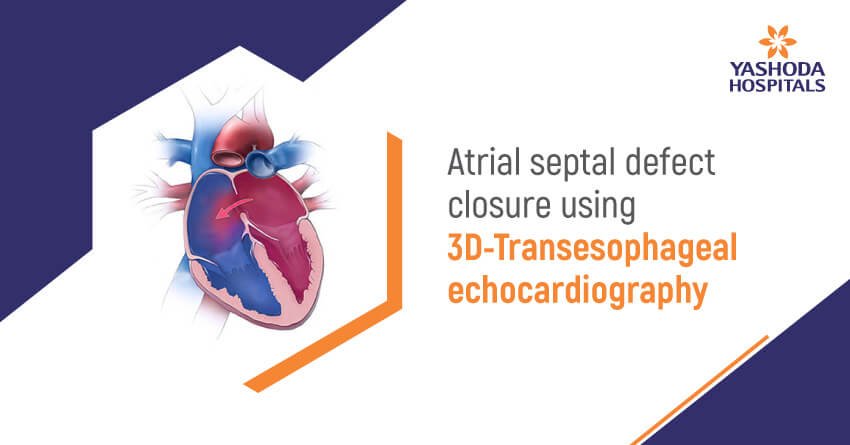 Atrial Septal Defect closure using 3D-Transesophageal echocardiography