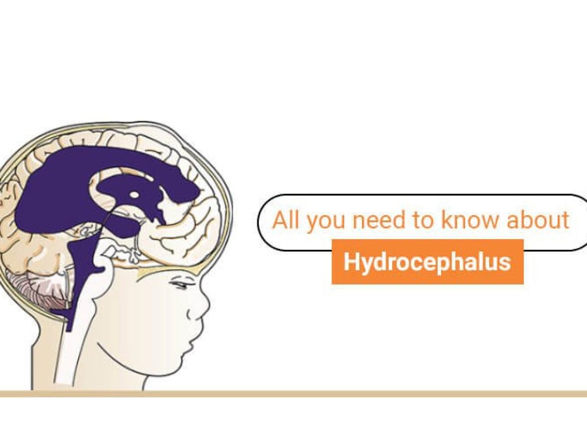 How Common Is Hydrocephalus