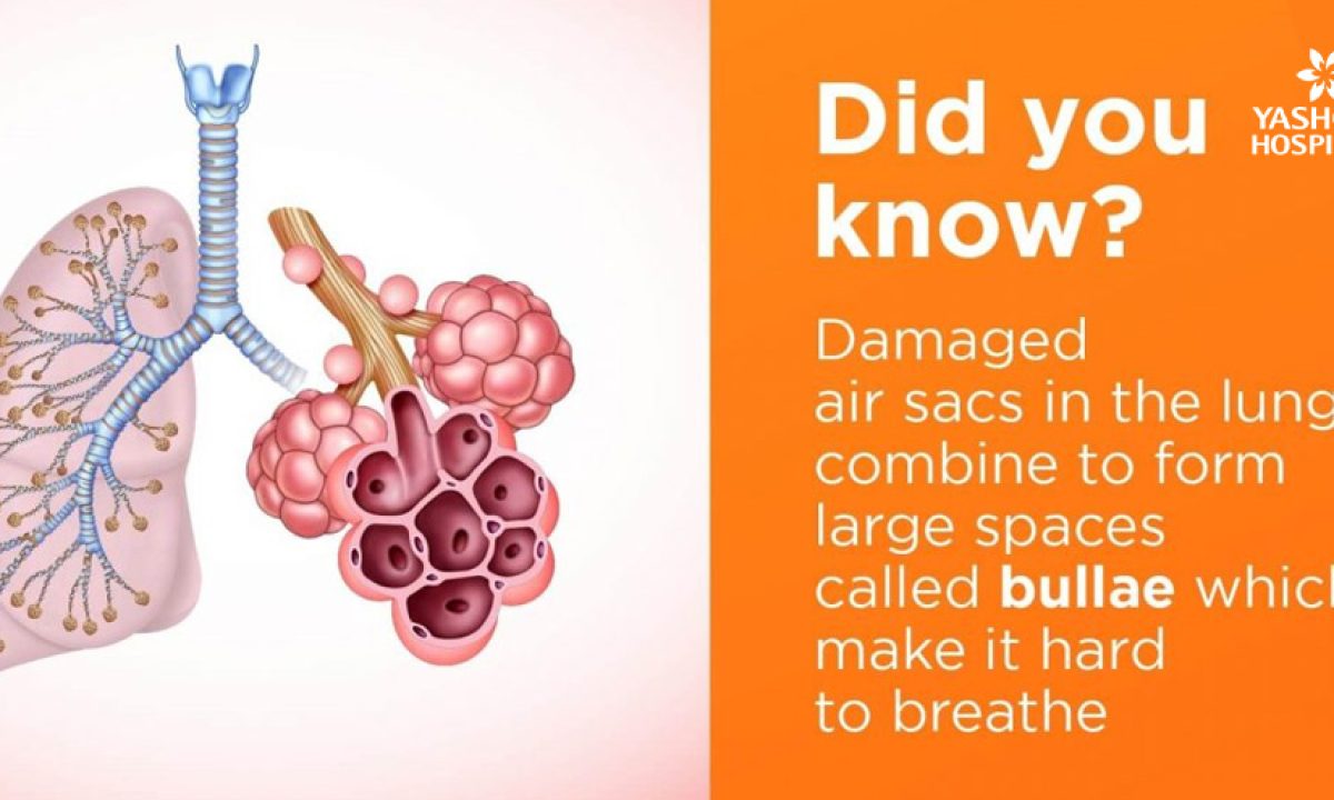Lung Bullae