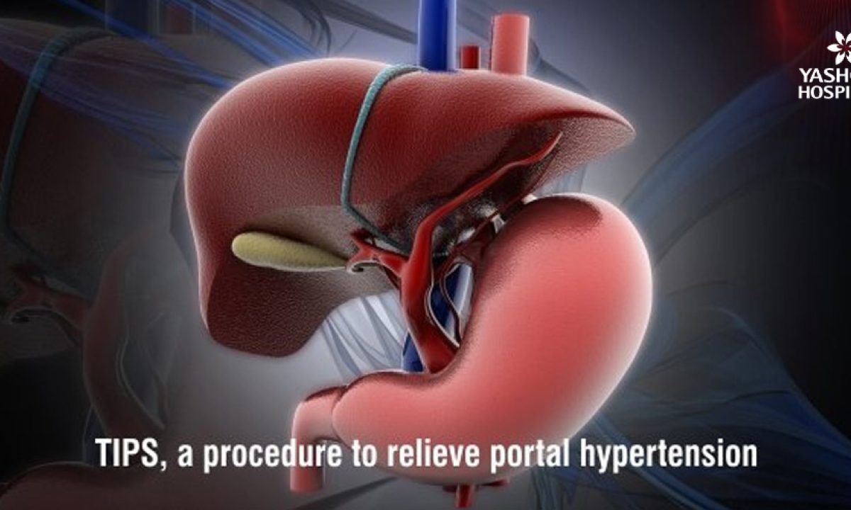 Transjugular Intrahepatic Portosystemic Shunt (tips) Assessment Of