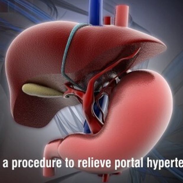 Human Liver Shunts Transjugular Intrahepatic Portosystemic Shunt