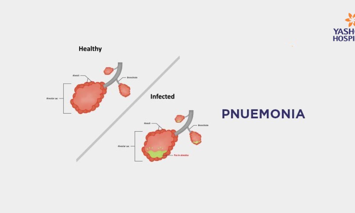 What Is Pneumonia Types Causes Diagnosis And Treatment