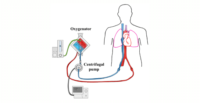 Awake ECMO Treatment