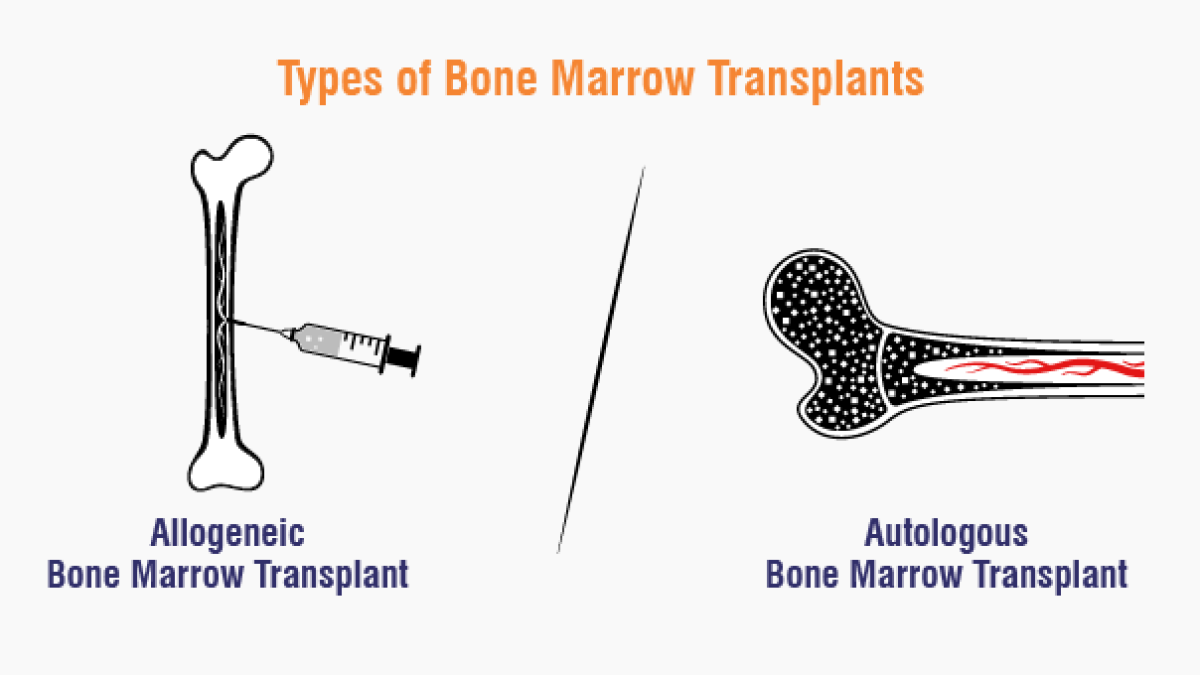 Bone Marrow Transplant Quotes