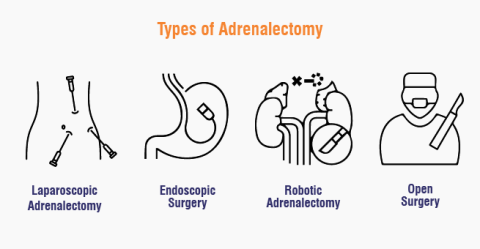 Understanding Adrenalectomy: Adrenal Gland Removal