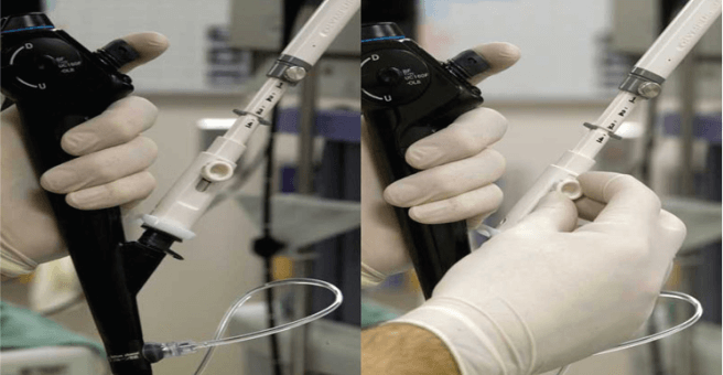 Latest Technical Advancements In Interventional Pulmonology ...