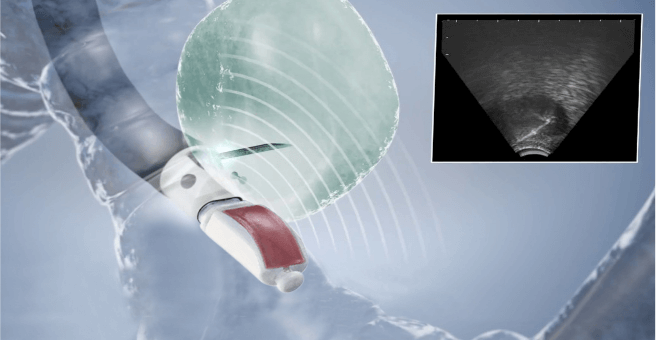 Latest Technical Advancements In Interventional Pulmonology ...