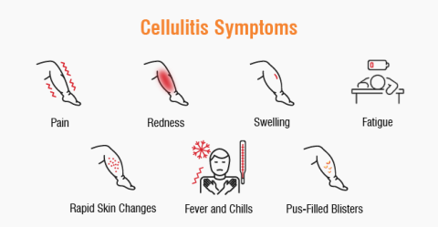 Cellulitis: Symptoms, Causes, Diagnosis, and Effective Treatment Options