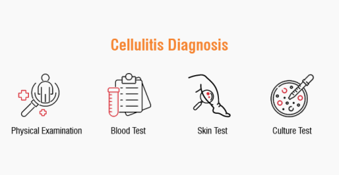 Cellulitis: Symptoms, Causes, Diagnosis, and Effective Treatment Options
