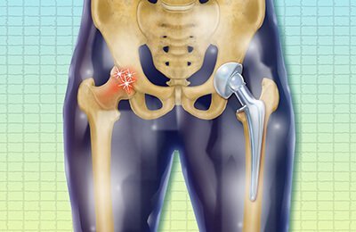 Hip Replacement Surgery: Procedure, Risks, Benefits, Recovery and Cost
