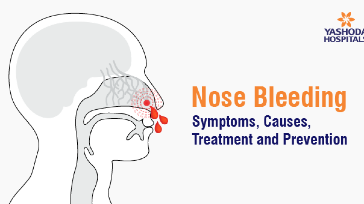 Nosebleed Medical Term