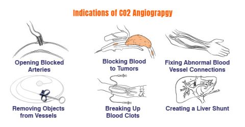 Carbon Dioxide (co2) Angiography: A Safe Alternative for Patients with ...