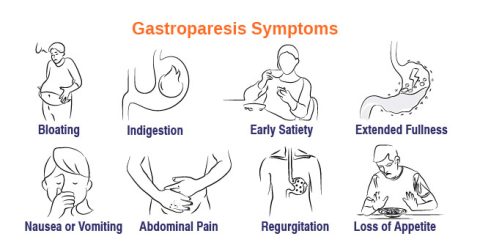 Gastroparesis: Symptoms, Causes, & Advanced Treatment