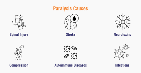 Paralysis Attack: Causes, Symptoms, Types and Treatment Options
