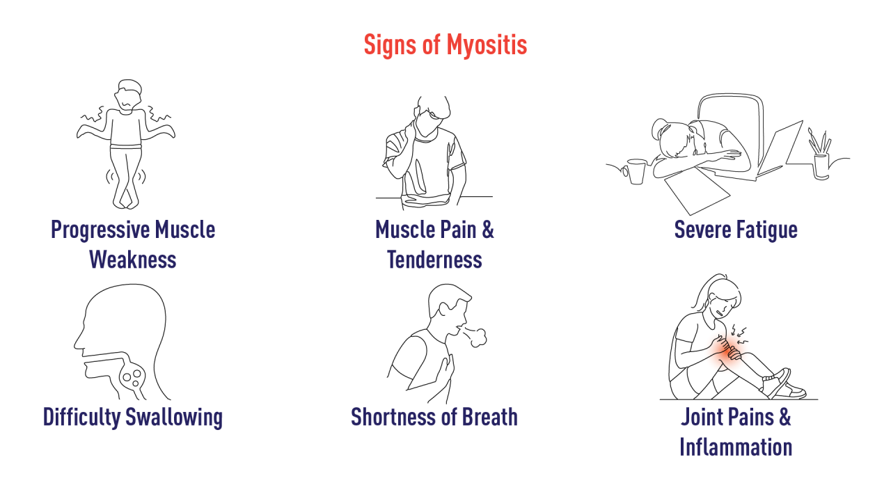 Myositis: Types, Symptoms, Causes, Diagnosis & Treatment