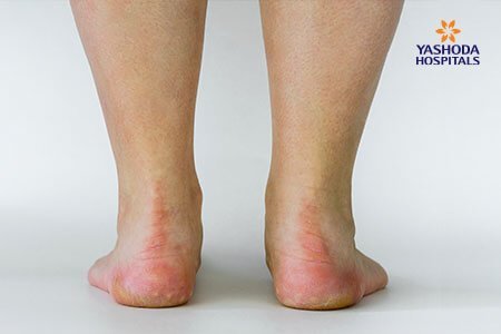 Adult Acquired Flatfoot: what are the Symptoms, Risk Factors, and ...