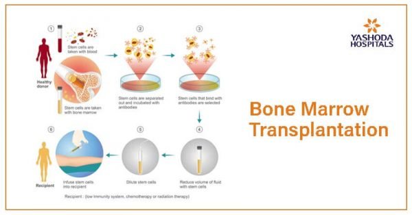 Bone Marrow transplantation in infants, children, adults and elderly