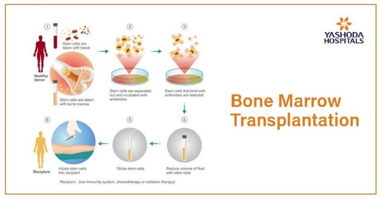 Bone Marrow transplantation in infants, children, adults and elderly