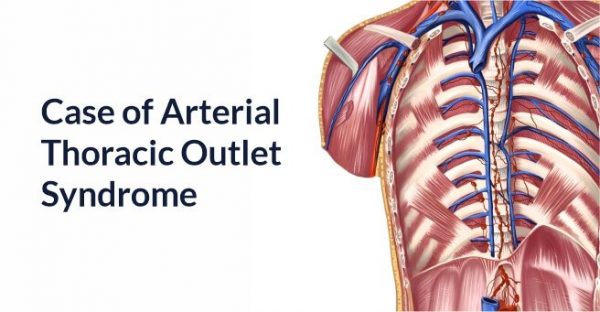 Arterial Thoracic Outlet Syndrome