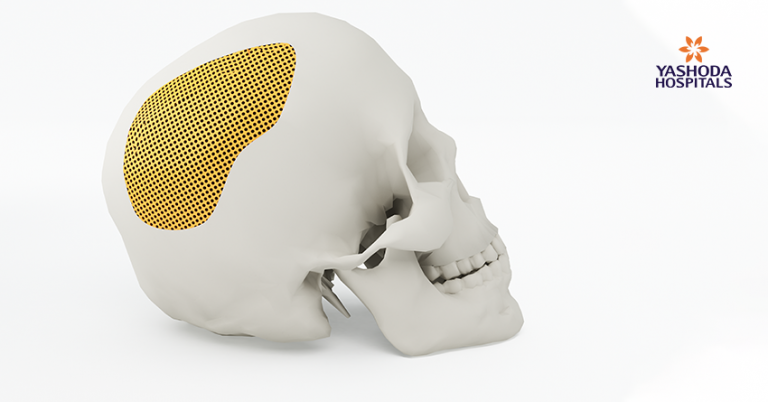 Doctors Prepare Artificial Skull Bone Using 3D Printing Technology ...