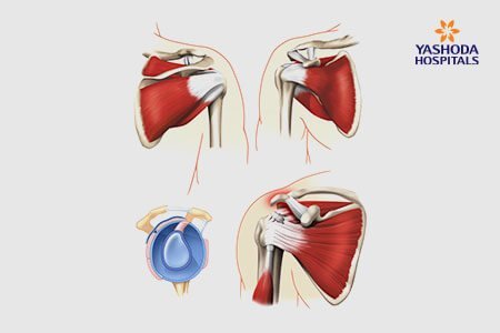 Biceps Tendon Injuries: Symptoms and Complications