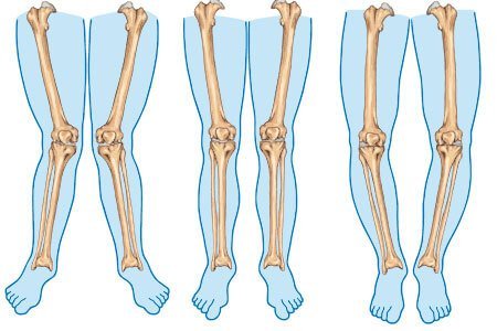Bowed Legs: Symptoms and Complications