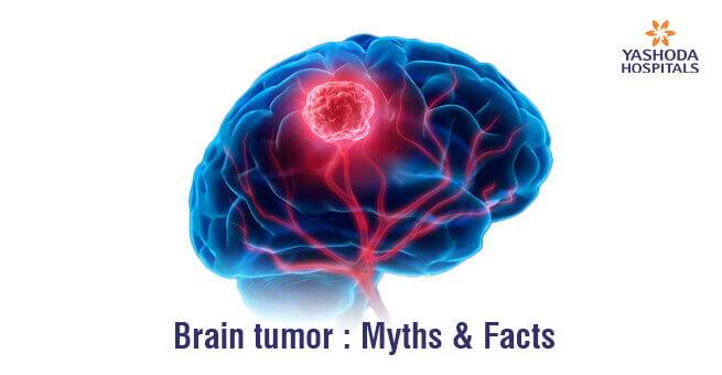 What is Brain Tumor? - Types, Symptoms, Causes, Diagnosis & Treatment