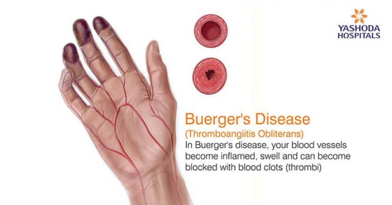 What is Buerger's disease ? Causes, Symptoms, Risk and Complications