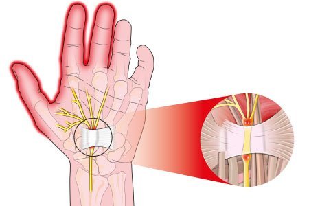 Ulnar Tunnel Syndrome: What are the Symptoms, Risk Factors and ...