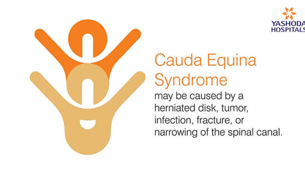 Cauda Equina Syndrome
