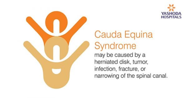 Cauda equina syndrome may be caused by a herniated disk, tumor ...