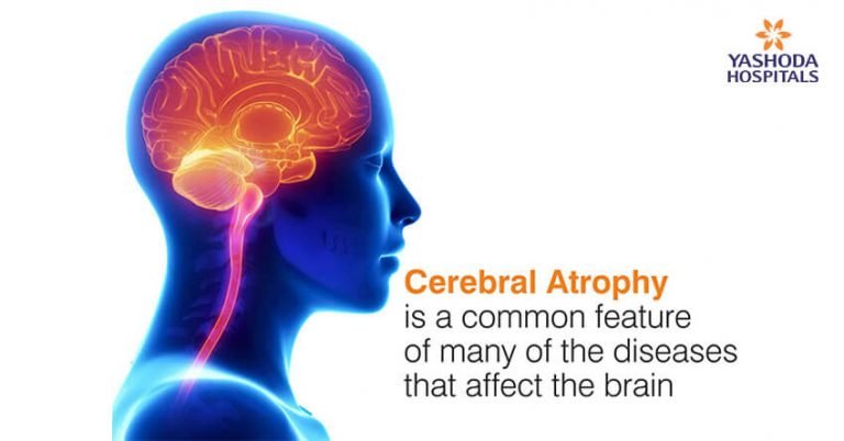 Cerebral Atrophy: Causes, Symptoms and Treatment