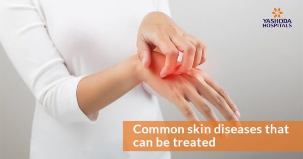 Skin Diseases: Causes, Symptoms, Prevention and Treatment