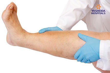 Compartment Syndrome: Diagnosis, Prevention and Treatment