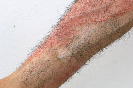 Compartment Syndrome: Symptoms and Complications