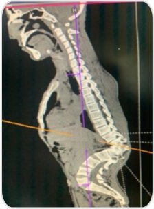 Role of Corpectomy in Spine Surgery at Yashoda Hospitals
