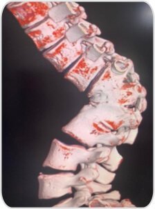 Role of Corpectomy in Spine Surgery at Yashoda Hospitals