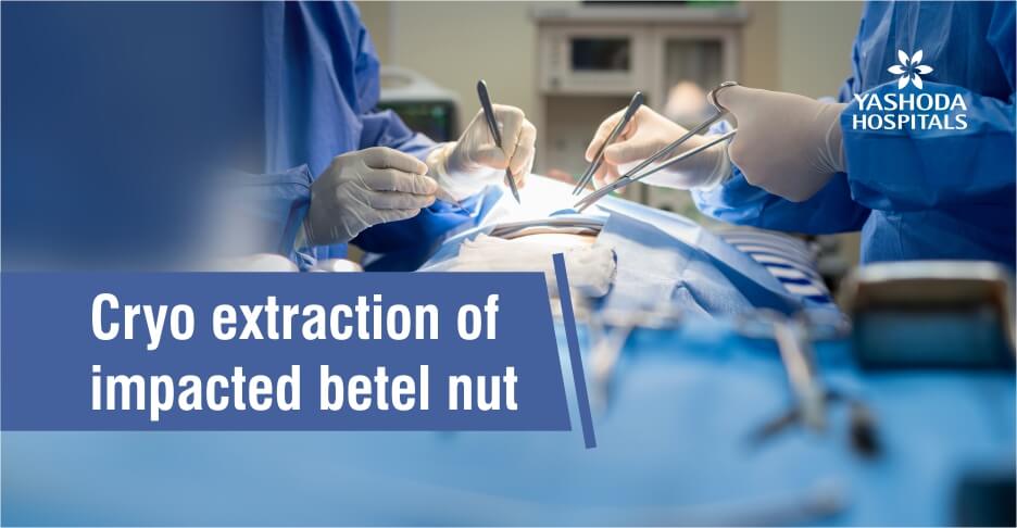 Cryo extraction of impacted betel nut - Yashoda Hospitals