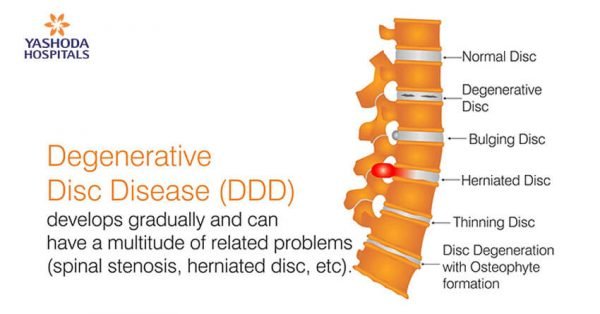 Degenerative Disc Disease develops gradually and can have a multitude ...