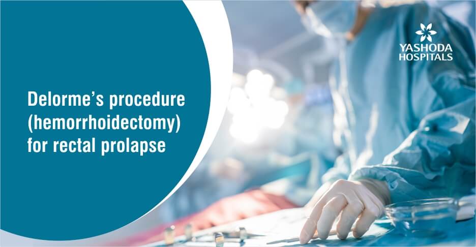 Delorme’s procedure (hemorrhoidectomy) for rectal prolapse - Yashoda ...