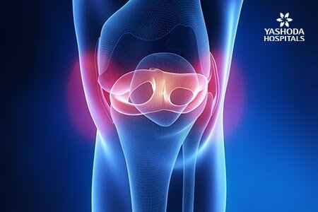 Discoid Meniscus: What is Discoid Meniscus, its Types and Causes?