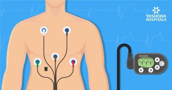 Electrophysiology Studies (EPS)