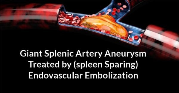 Giant Splenic Artery Aneurysm Treated by (Spleen Sparing) Endovascular ...