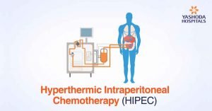 Hyperthermic Intraperitoneal Chemotherapy (HIPEC) for Advanced ...